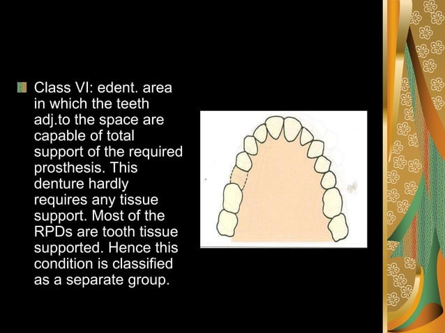 Kennedy classification | PPTX