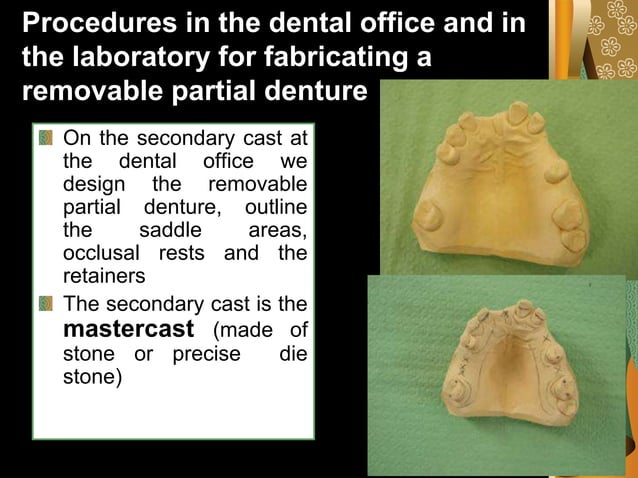 Kennedy classification | PPTX