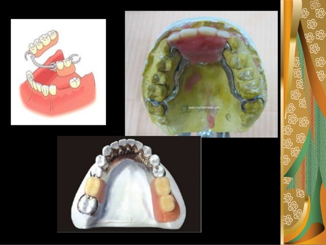 Kennedy classification