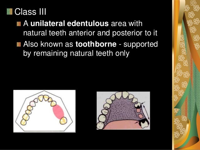 Kennedy classification
