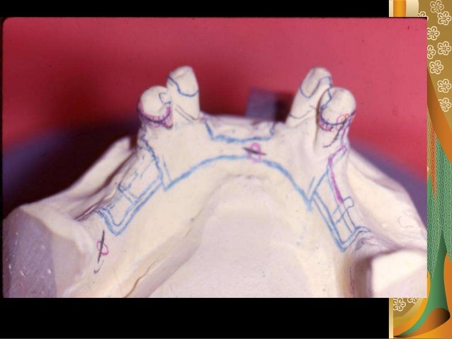 Kennedy classification