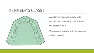Kennedy’s Classification in Cast Partial Denture | PPTX