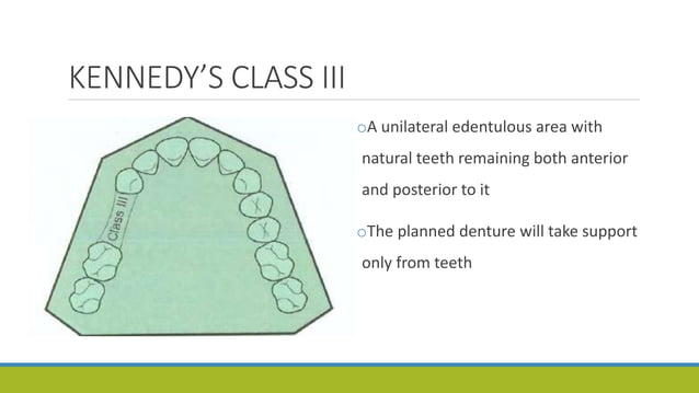 Kennedy’s Classification in Cast Partial Denture | PPTX | Dental Health ...