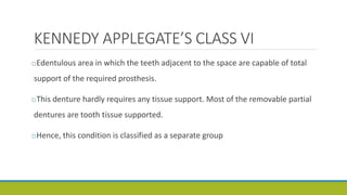 Kennedy’s Classification in Cast Partial Denture | PPTX