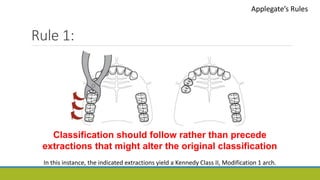 Kennedy’s Classification in Cast Partial Denture | PPTX
