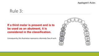 Kennedy’s Classification in Cast Partial Denture | PPTX