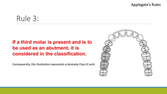 Kennedy’s Classification in Cast Partial Denture | PPTX | Dental Health ...