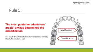 Kennedy’s Classification in Cast Partial Denture | PPTX