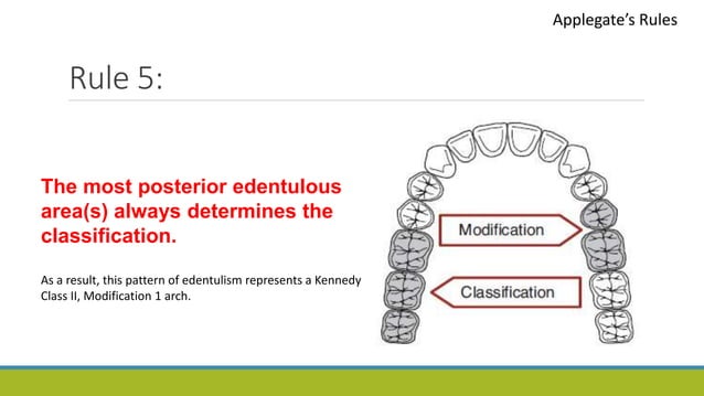 Kennedy’s Classification in Cast Partial Denture | PPTX | Dental Health ...