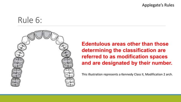 Kennedy’s Classification in Cast Partial Denture | PPTX | Dental Health ...