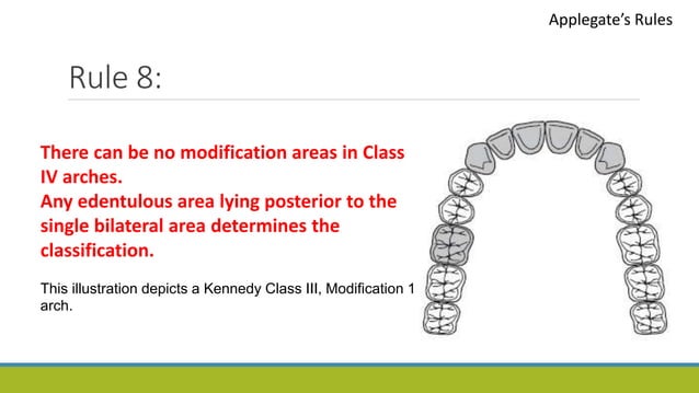 Kennedy’s Classification in Cast Partial Denture | PPTX | Dental Health ...