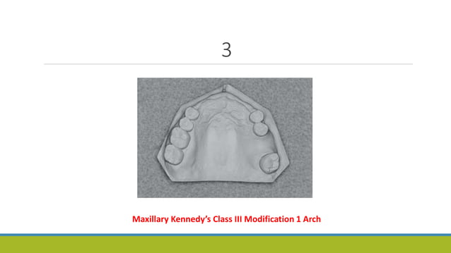 Kennedy’s Classification in Cast Partial Denture | PPTX | Dental Health ...