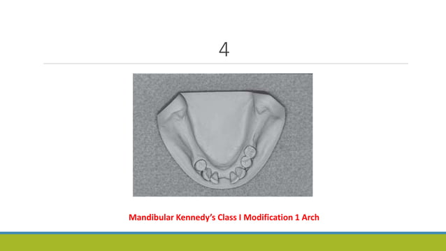 Kennedy’s Classification in Cast Partial Denture | PPTX | Dental Health ...