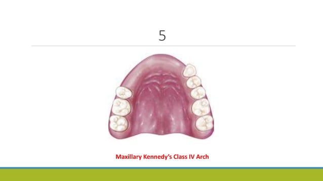 Kennedy’s Classification in Cast Partial Denture | PPTX | Dental Health ...