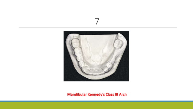 Kennedy’s Classification in Cast Partial Denture | PPTX | Dental Health ...