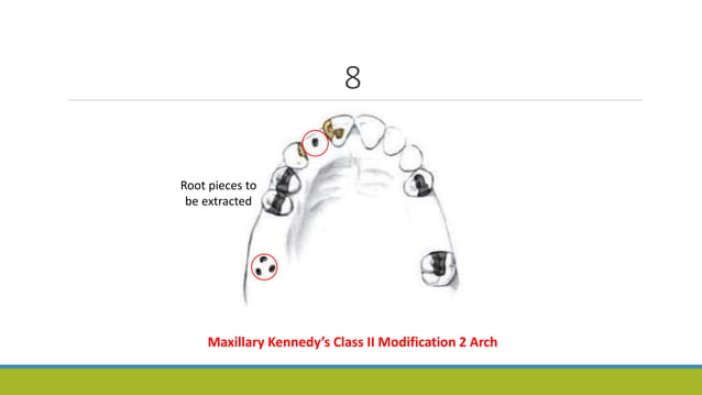 Kennedy’s Classification in Cast Partial Denture | PPTX | Dental Health ...