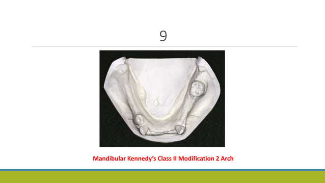 Kennedy’s Classification in Cast Partial Denture | PPTX | Dental Health ...