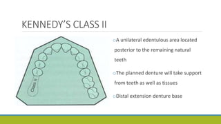 Kennedy’s Classification in Cast Partial Denture | PPTX