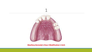Kennedy’s Classification in Cast Partial Denture | PPT