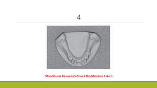 Kennedy’s Classification in Cast Partial Denture | PPT