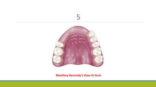 Kennedy’s Classification in Cast Partial Denture | PPT