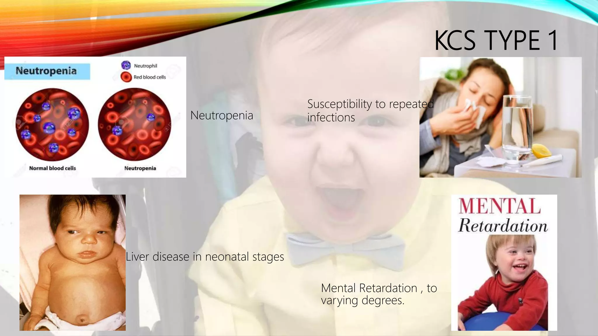 Kenny Caffey Syndrome | PPTX