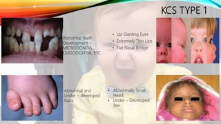 Kenny Caffey Syndrome | PPTX