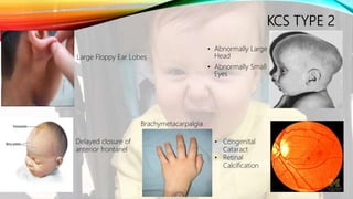 Kenny Caffey Syndrome | PPTX