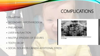 Kenny Caffey Syndrome | PPTX