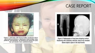 Kenny Caffey Syndrome | PPTX