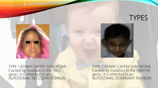 Kenny Caffey Syndrome | PPTX