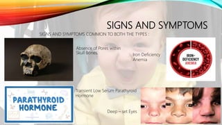 Kenny Caffey Syndrome | PPTX