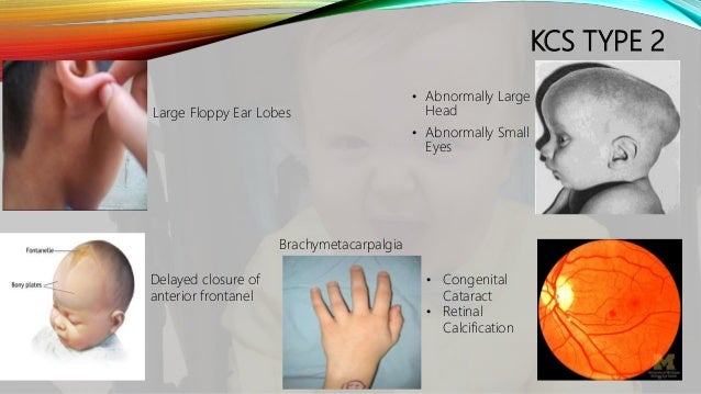 Kenny Caffey Syndrome