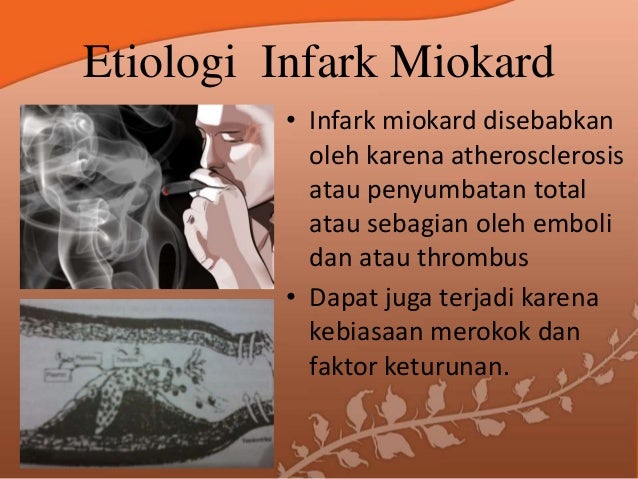 Kep.kar infark miokard