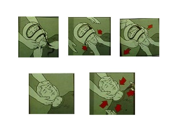 Kepatahan immobilisasi-transport-wound industries | PPT