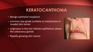 Keratoacanthoma | PPTX