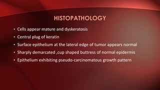 Keratoacanthoma Histology