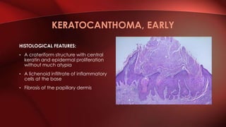 Keratoacanthoma Histology