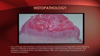 Keratoacanthoma Histology