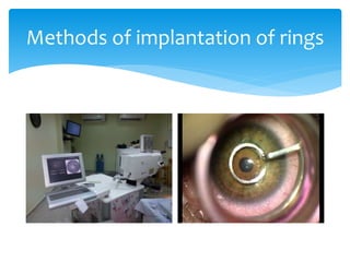 Kerarings complications | PPTX