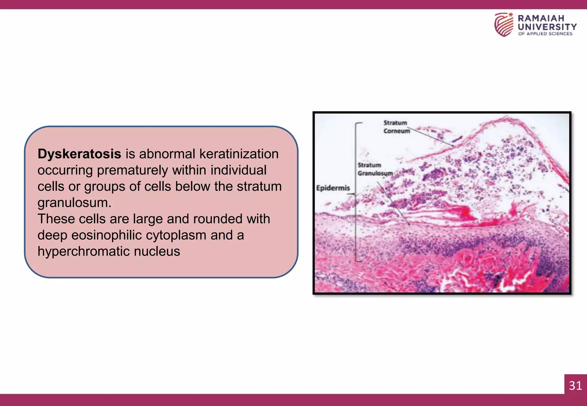 Gingival Keratinization | PPTX
