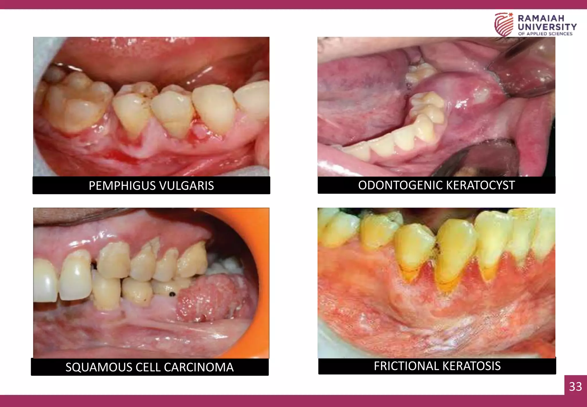 Gingival Keratinization | PPTX