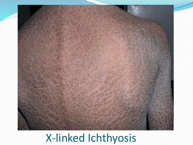 Keratinization disorders by M.Y.Abdel_Mawla,MD