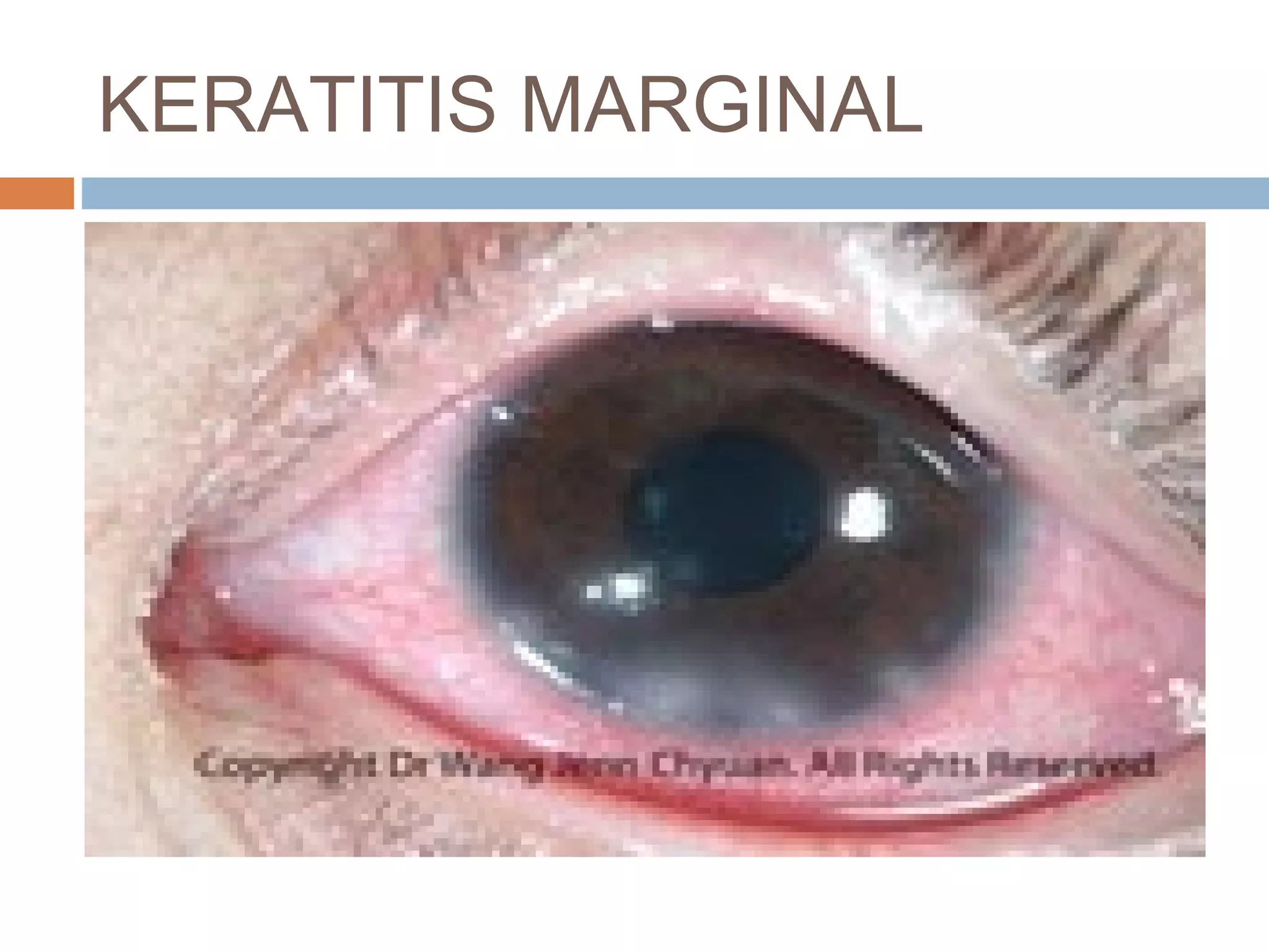 Keratitis | PPT