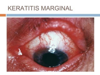 Keratitis | PPT