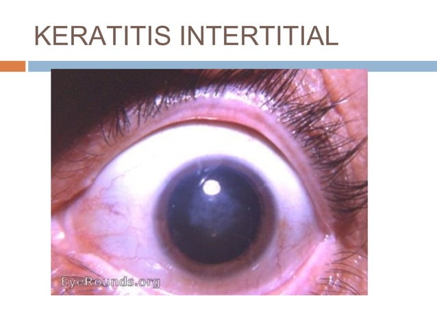 Keratitis | PPT