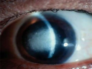 Disciform Keratitis Vs Interstitial Keratitis