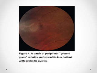 Interstitial Keratitis Syphilis