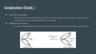 Keratitis | PPTX
