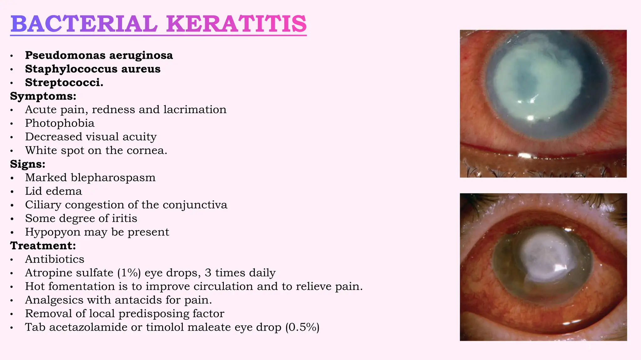 KERATITIS.pptx